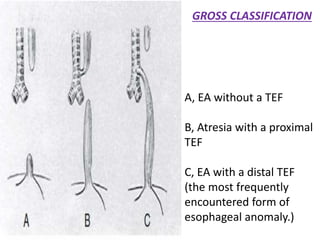 PRANAYA PPT - TRACHEOESOPAHAGEAL FISTULA ( EA-TEF ) | PPTX
