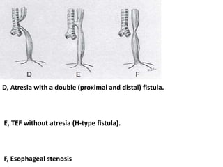 PRANAYA PPT - TRACHEOESOPAHAGEAL FISTULA ( EA-TEF ) | PPTX