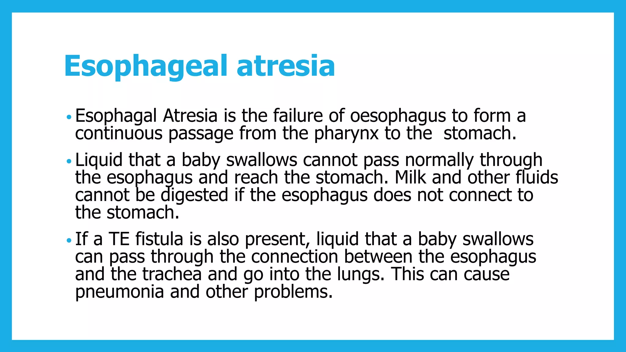 Congenital anomalies of esophagus | PDF