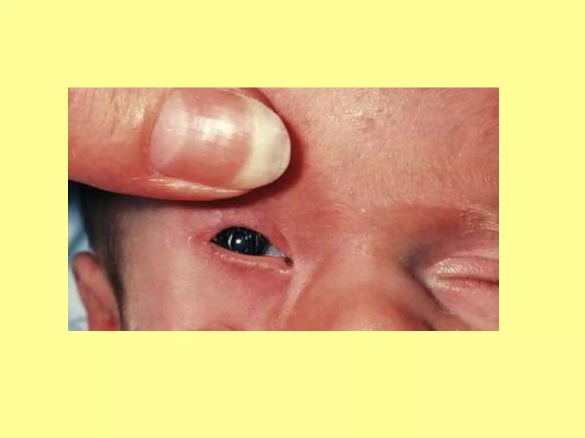 Congenital anomalies of eyelid Quick Review | PPTX
