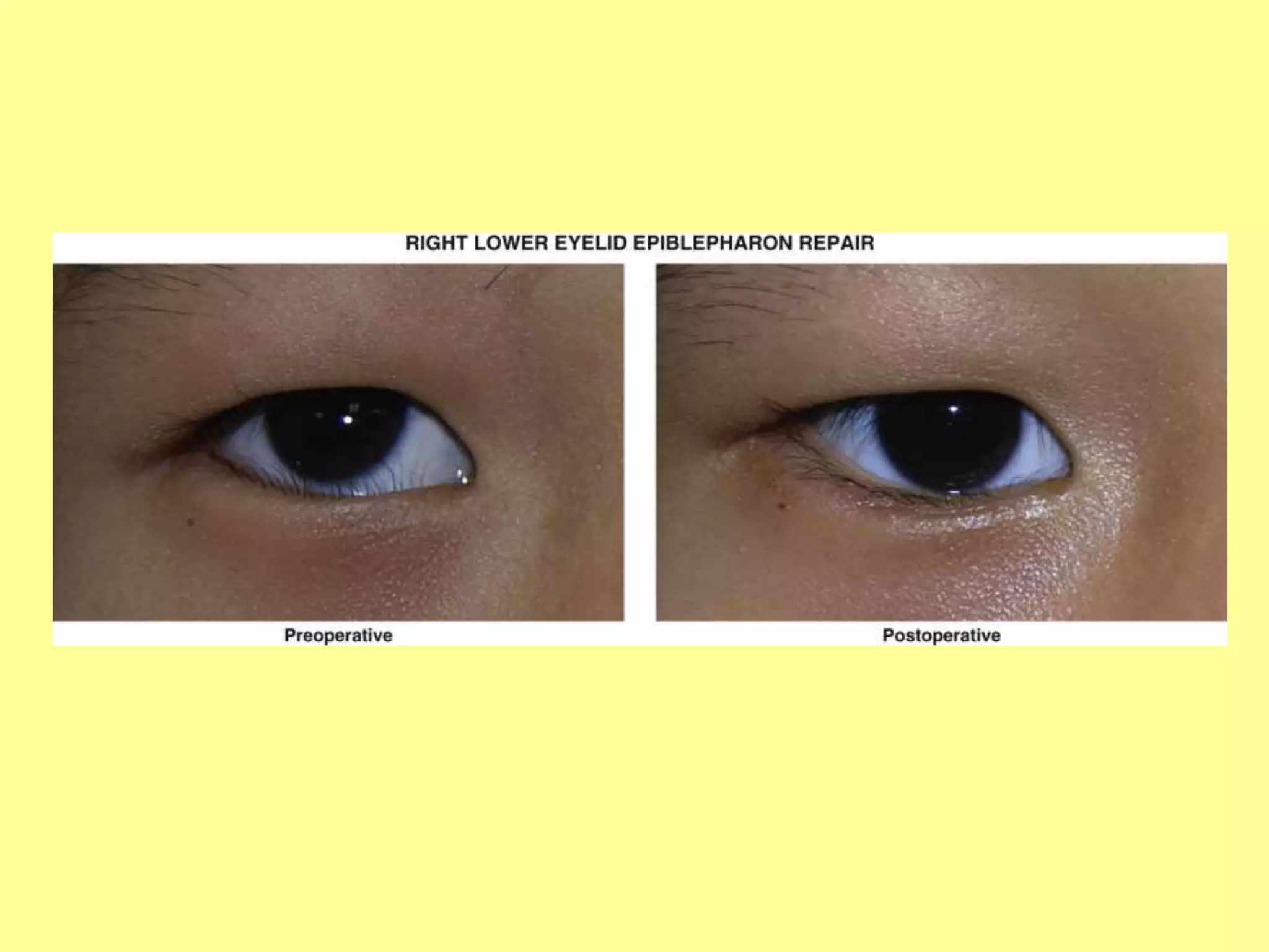 Congenital anomalies of eyelid Quick Review | PPTX