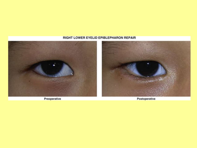 Congenital anomalies of eyelid Quick Review | PPTX | Eye and Vision ...