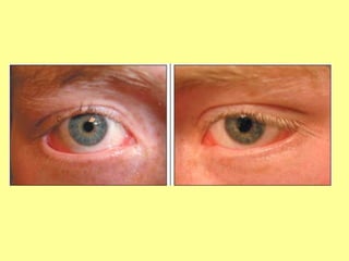 Congenital anomalies of eyelid Quick Review | PPTX