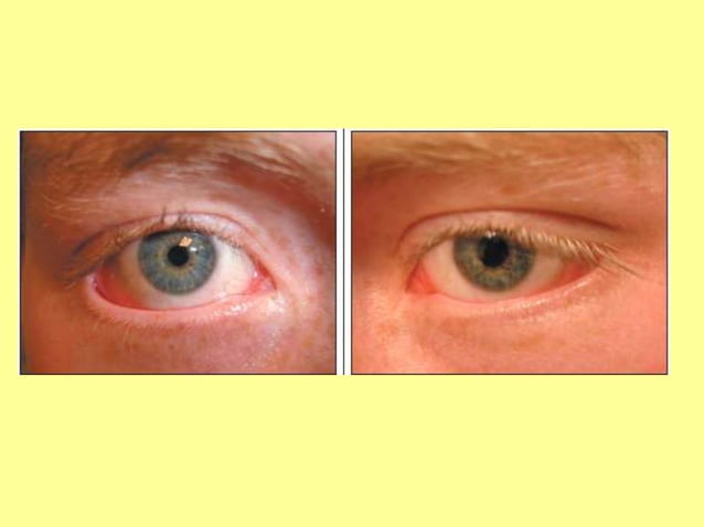Congenital anomalies of eyelid Quick Review | PPTX | Eye and Vision ...