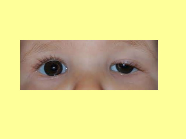 Congenital anomalies of eyelid Quick Review | PPTX | Eye and Vision ...