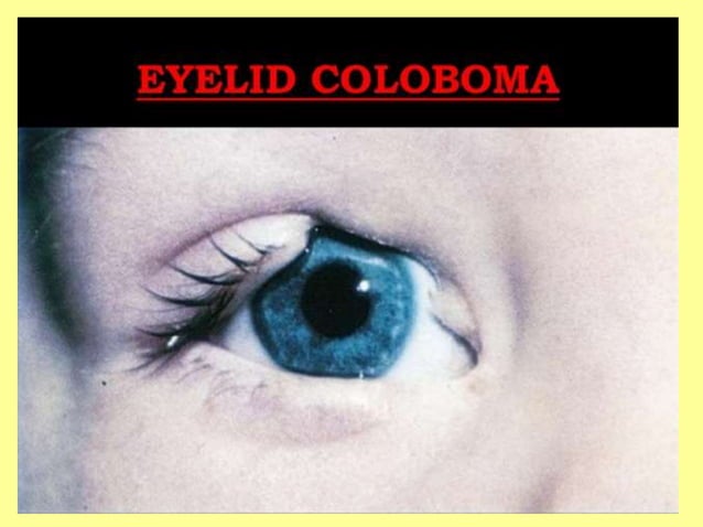 Congenital anomalies of eyelid Quick Review | PPTX | Eye and Vision ...