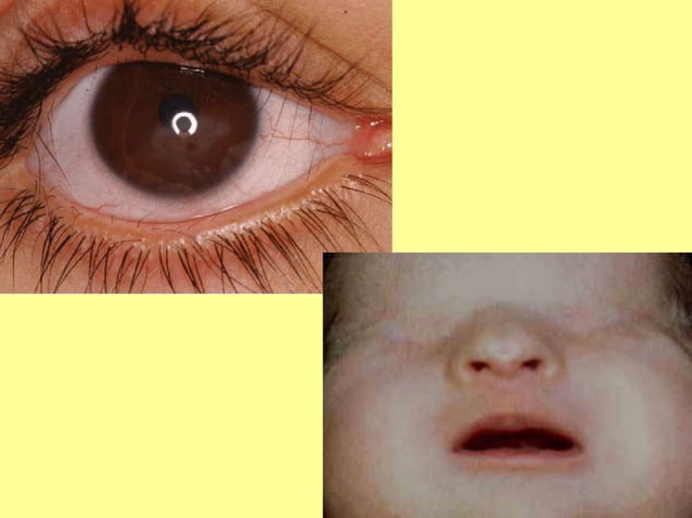Congenital anomalies of eyelid Quick Review | PPTX | Eye and Vision ...