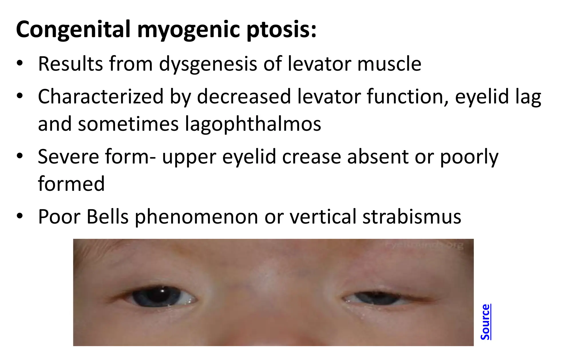 Congenital Anomalies of Eyelids and Orbit Dr. Prabhat Devkota.pptx