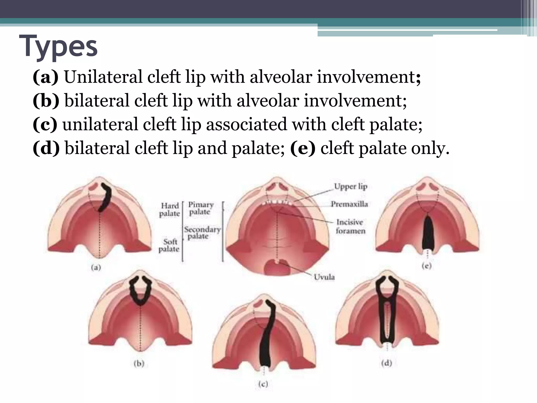 Congenital anomalies of face & urinary system Dr Hatem El Gohary | PPTX