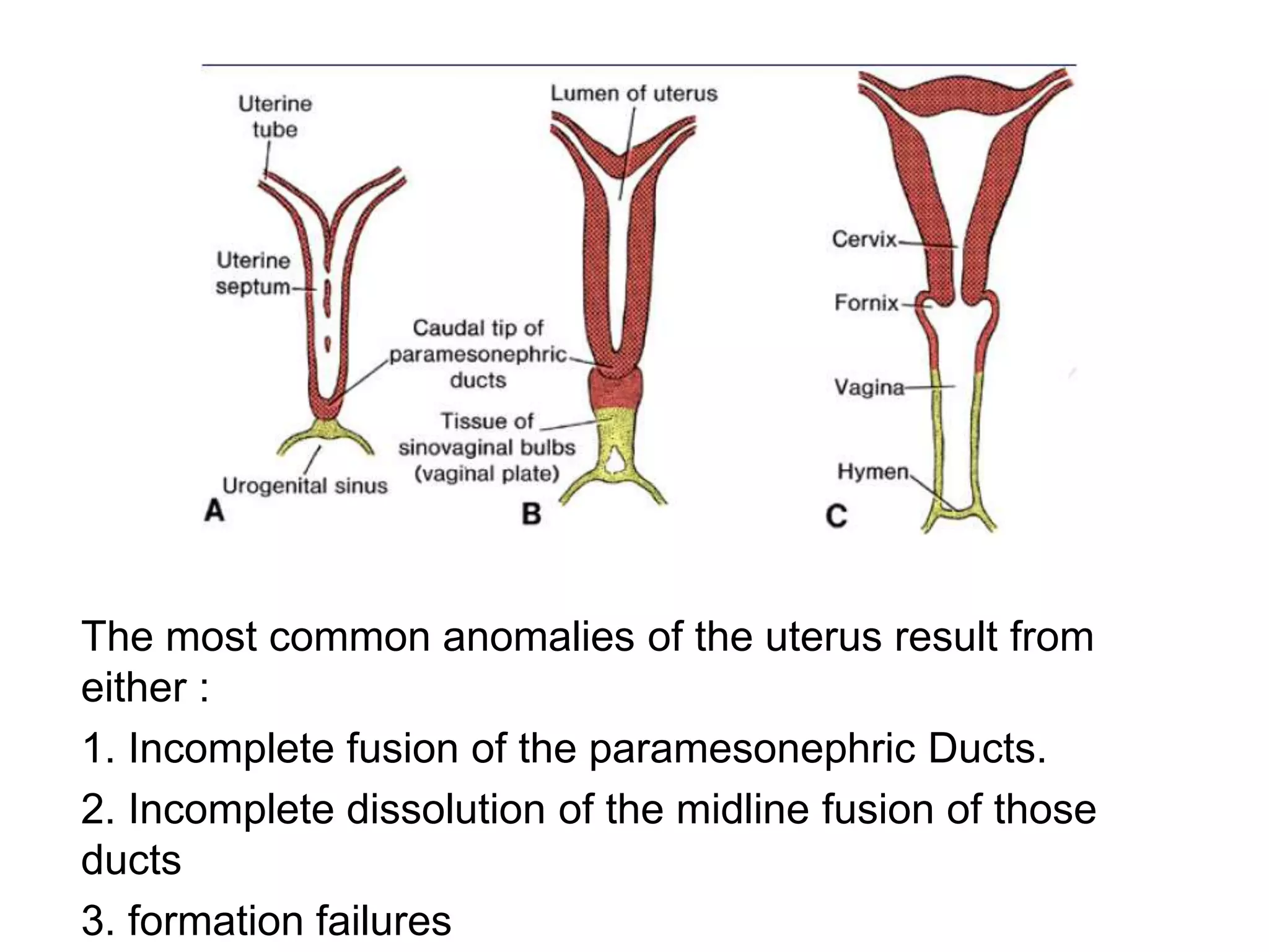 Congenital anomalies of female reproductive system | PPTX