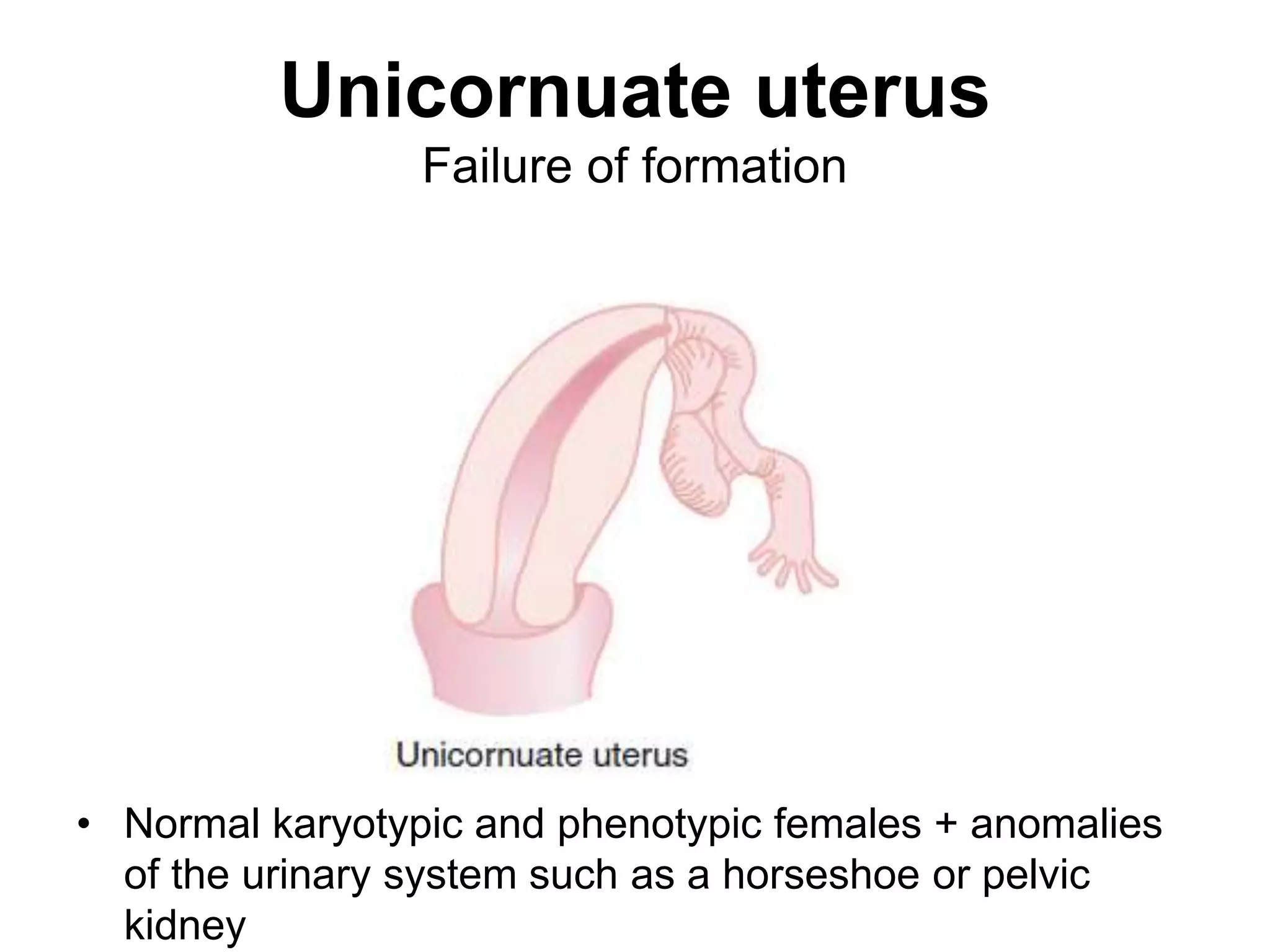 Congenital Anomalies Of Female Reproductive System Ppt