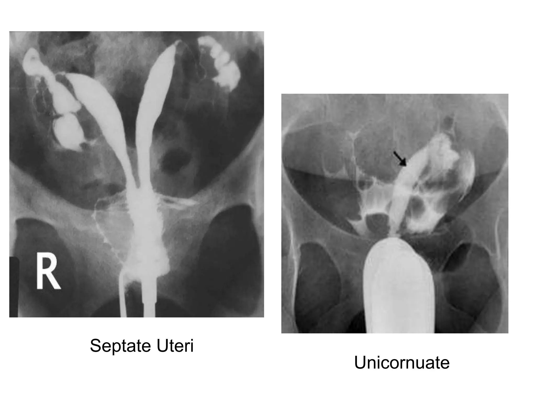 Congenital anomalies of female reproductive system | PPTX