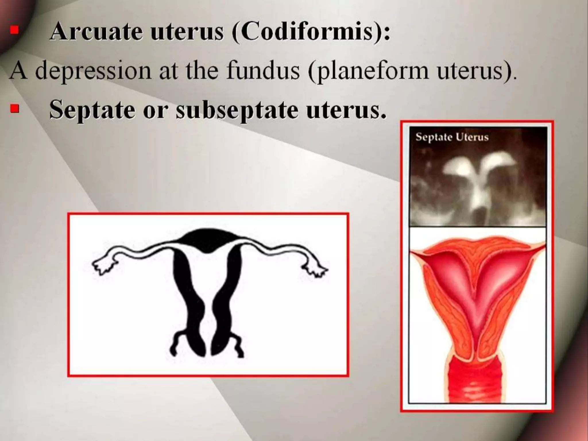 Congenital anomalies of female reproductive system | PPTX