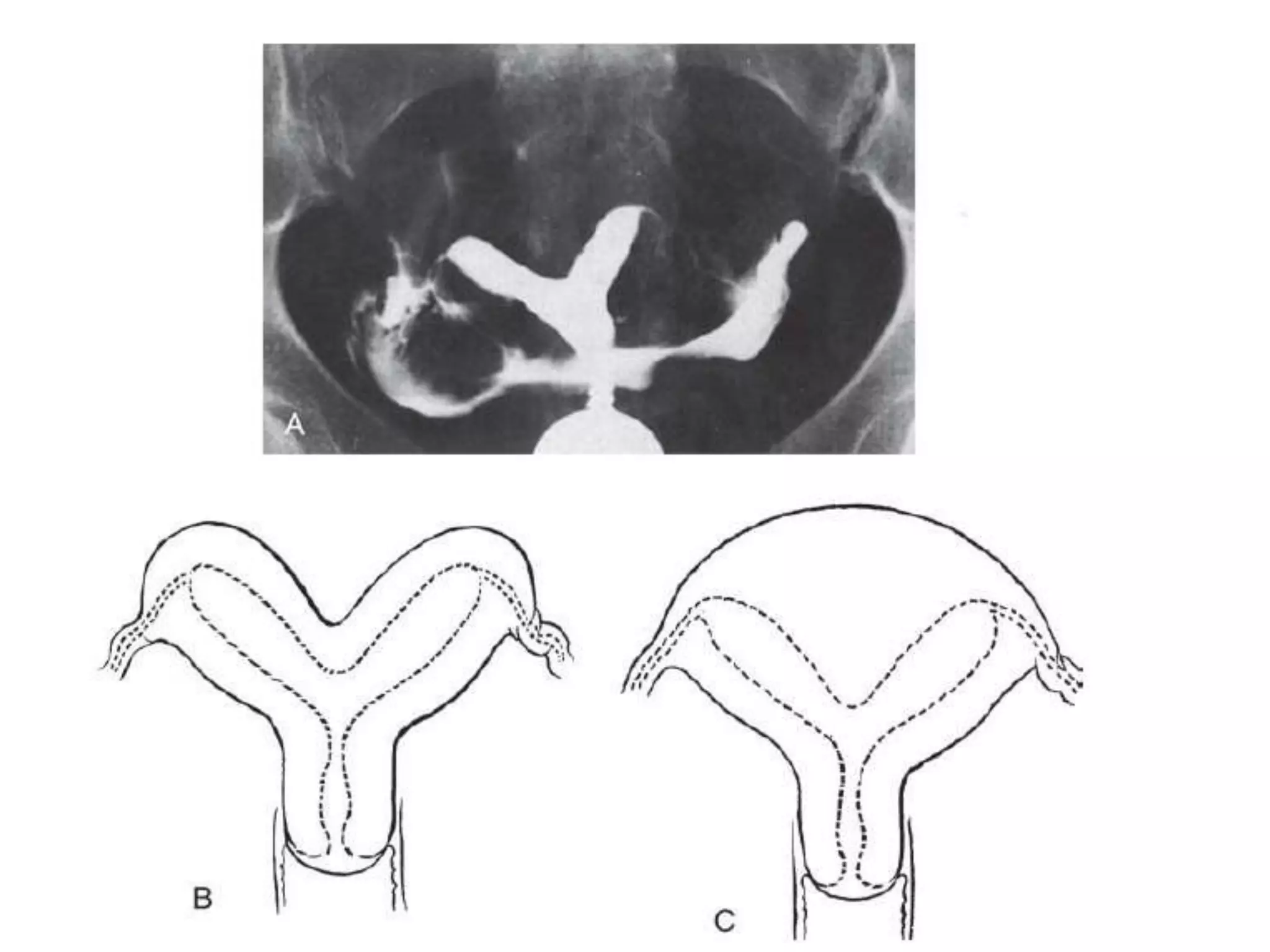 Congenital anomalies of female reproductive system | PPTX
