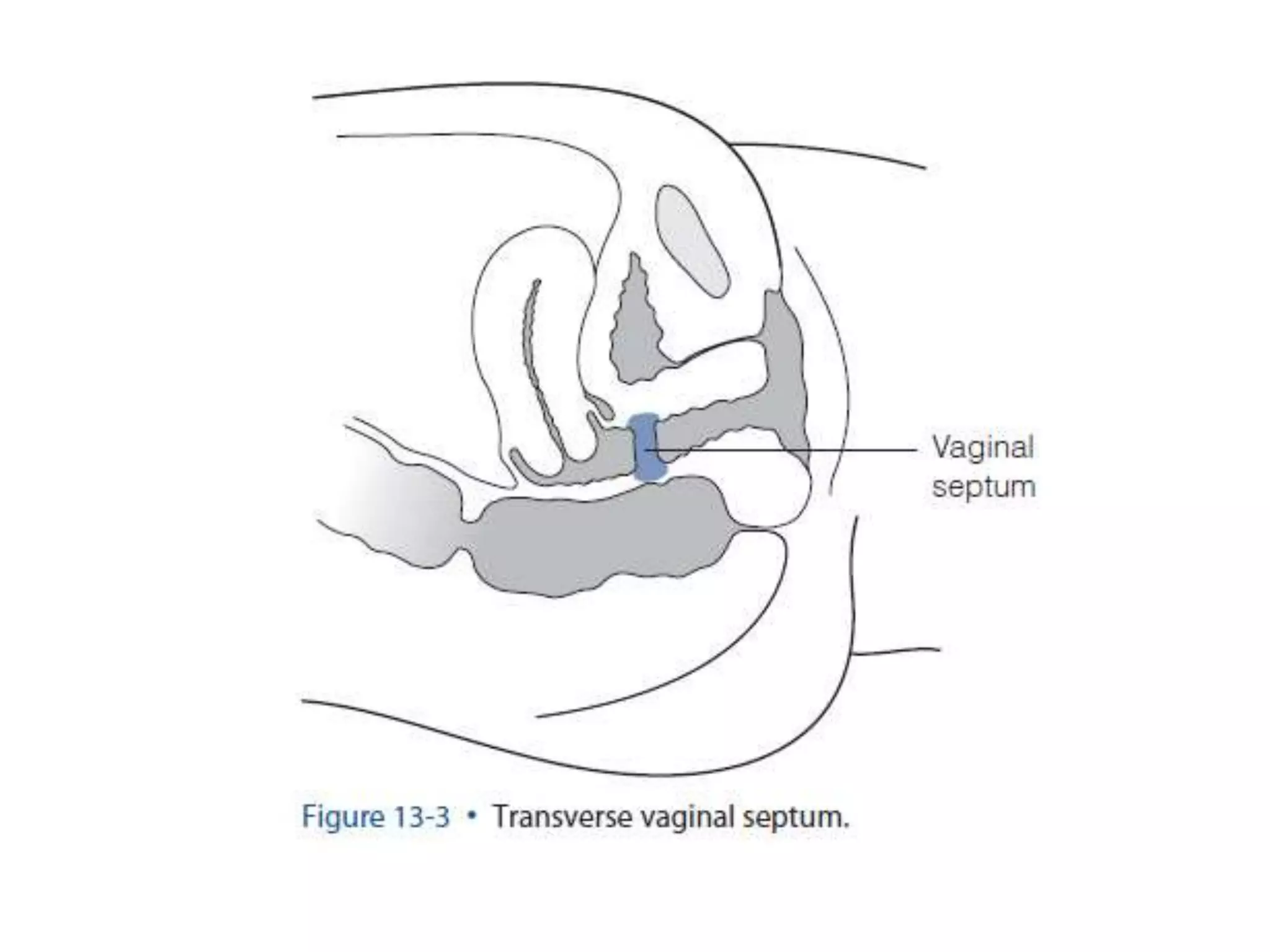 Congenital Anomalies Of Female Reproductive System Ppt