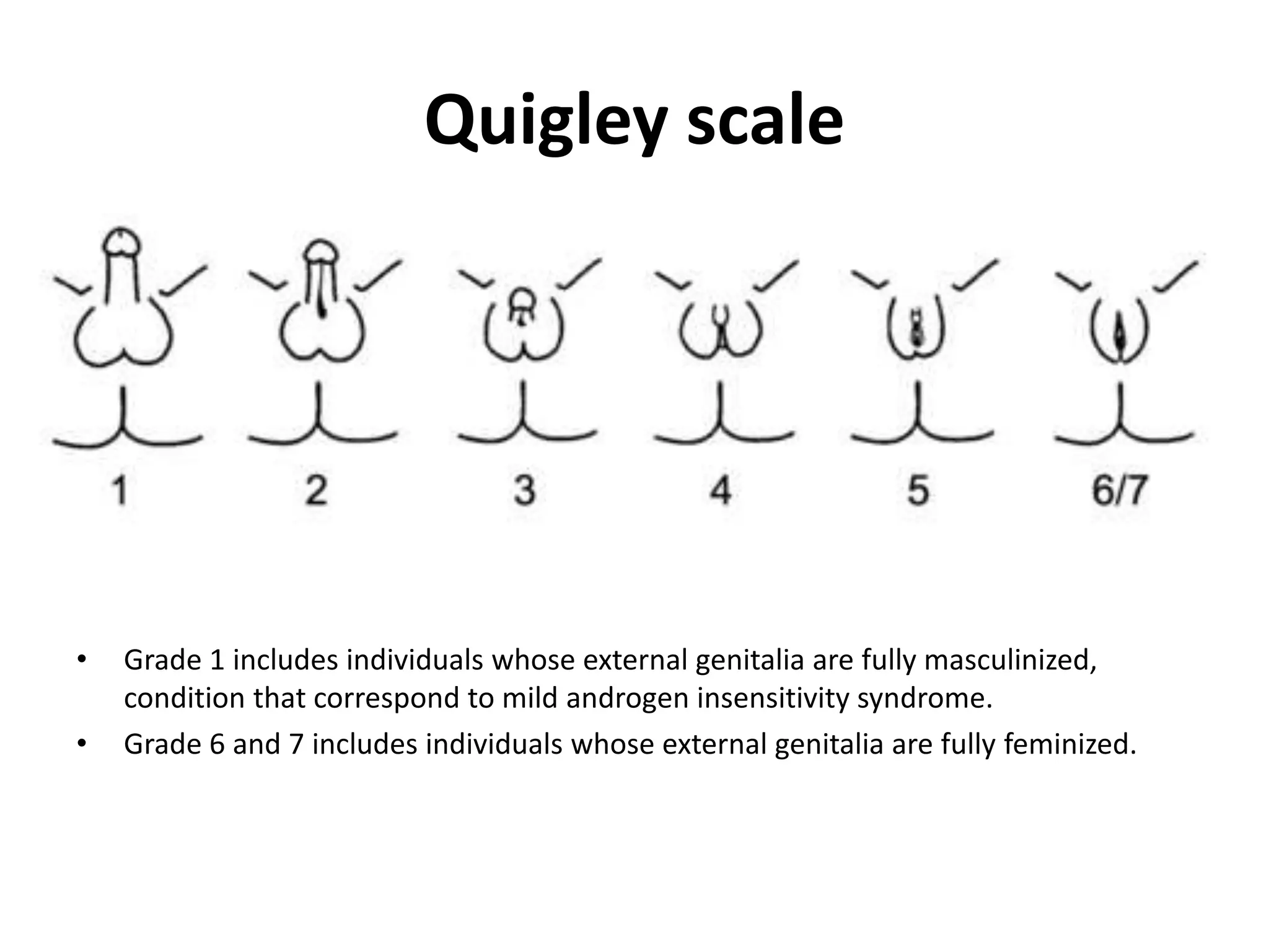 Congenital anomalies of female reproductive system | PPTX