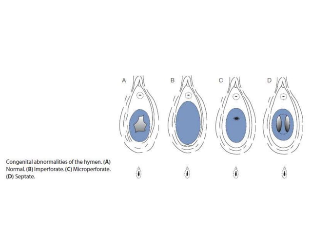 Congenital Anomalies Of Female Reproductive System Ppt