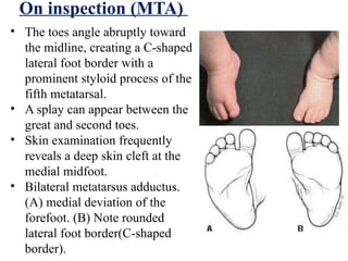 Congenital Anomalies of Foot and Toes. | PPTX