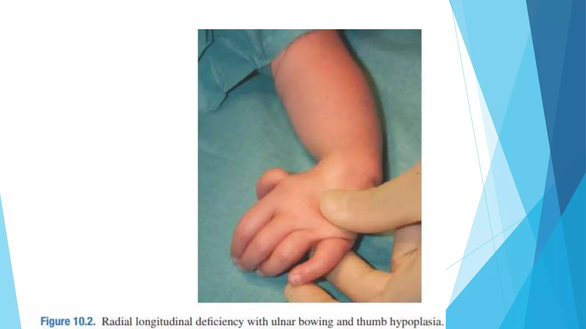 Congenital anomalies of hand | PPTX
