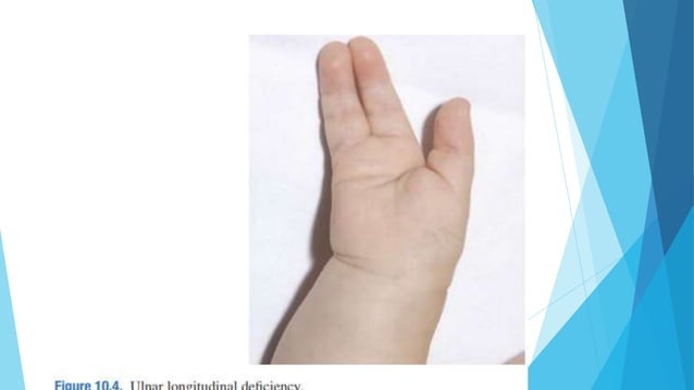 Congenital anomalies of hand | PPTX | Bone and Joint Conditions ...
