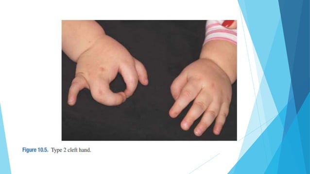 Congenital anomalies of hand | PPTX | Bone and Joint Conditions ...