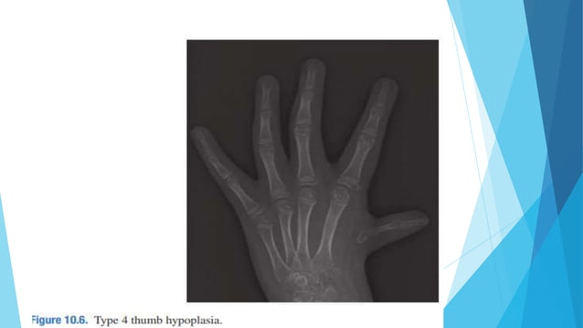Congenital anomalies of hand | PPTX | Bone and Joint Conditions ...