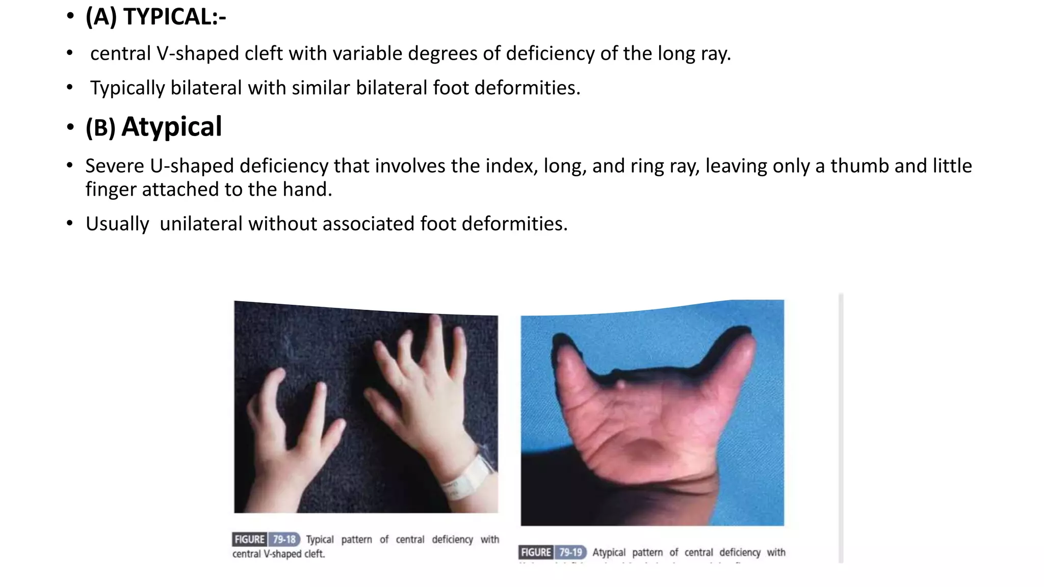 Congenital anomalies of the hand | PPTX