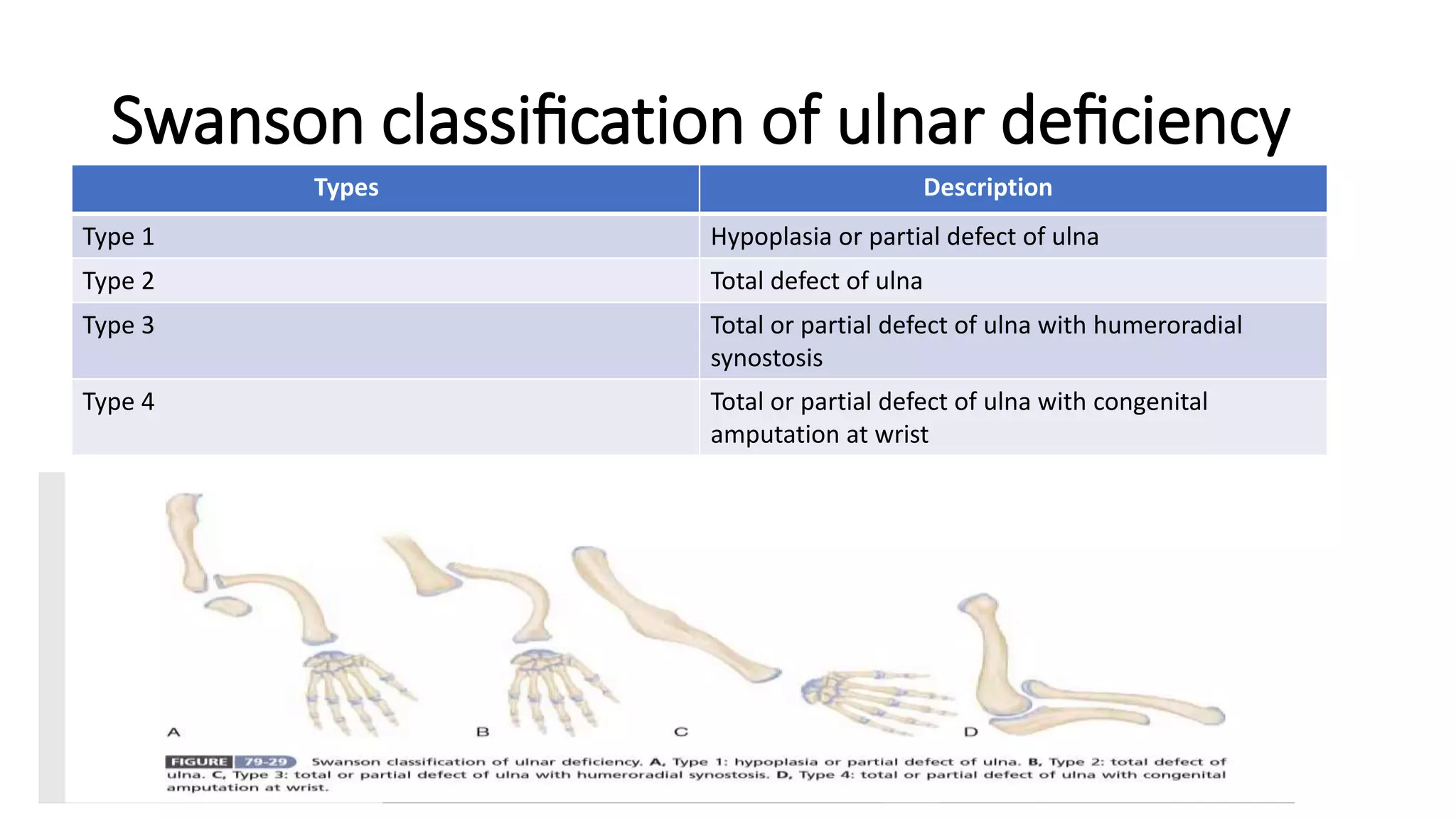 Congenital anomalies of the hand | PPTX