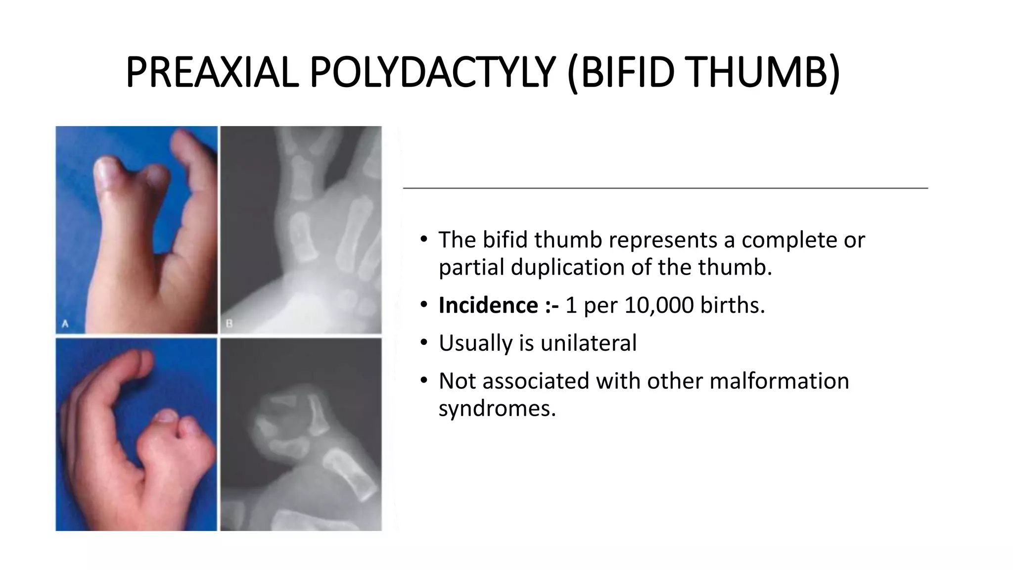 Congenital anomalies of the hand | PPTX