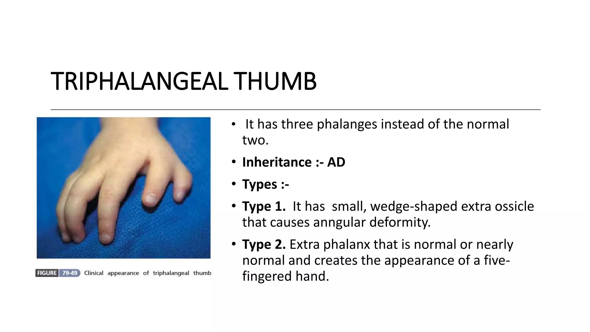 Congenital anomalies of the hand | PPTX