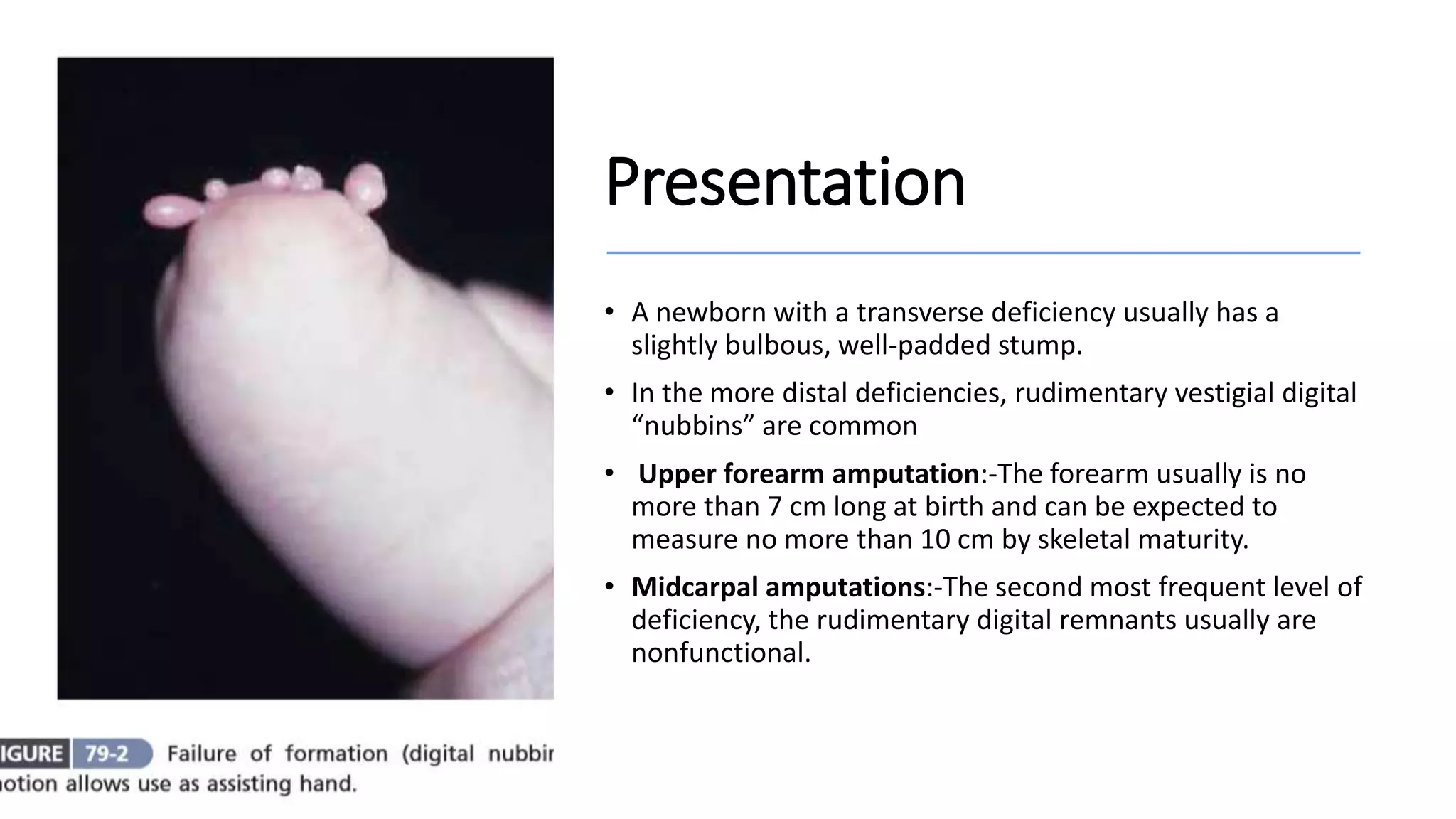 Congenital anomalies of the hand | PPTX