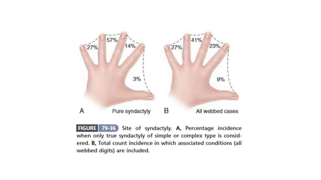 Congenital anomalies of the hand | PPTX | Death, Injury, or Military ...