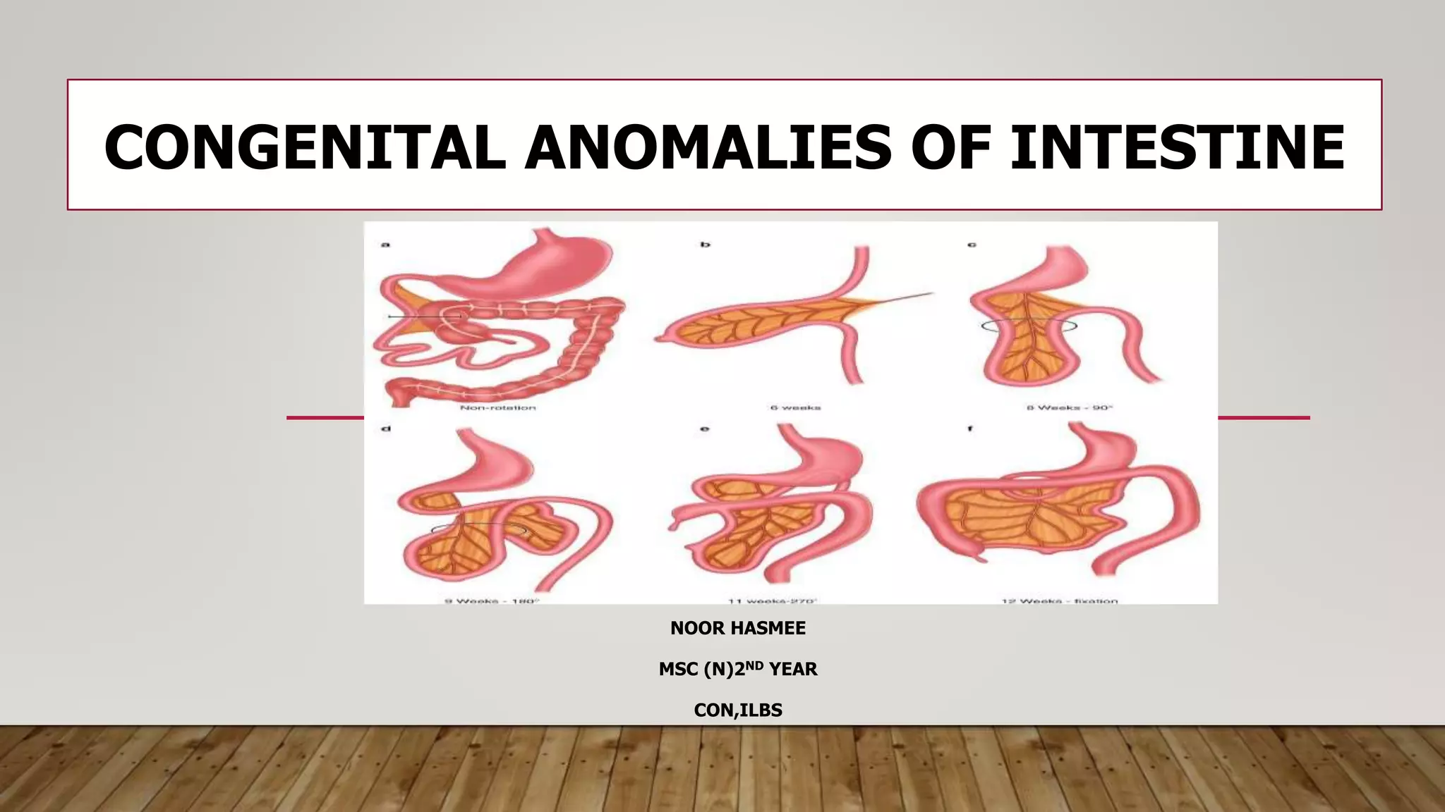 congenital anomalies of intestine ppt.pptx