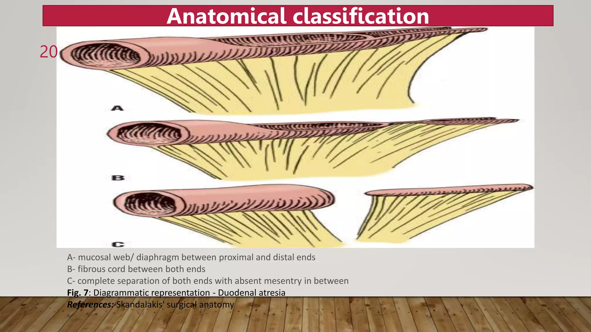 congenital anomalies of intestine ppt.pptx
