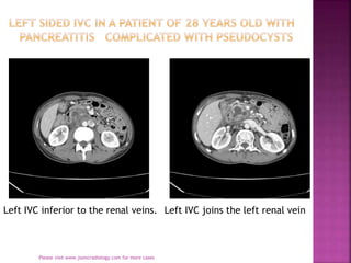 Congenital anomalies of IVC | PPTX