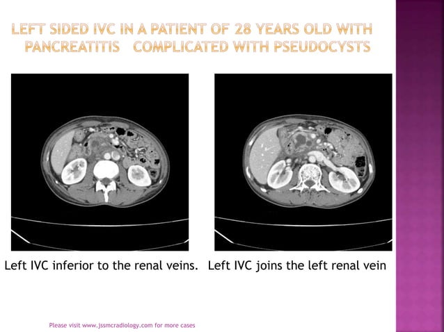 Congenital anomalies of IVC | PPTX