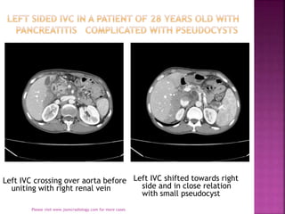 Congenital anomalies of IVC | PPTX