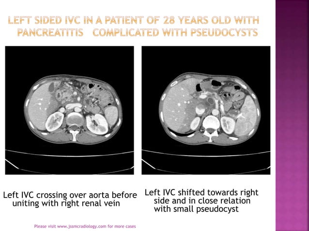 Congenital anomalies of IVC | PPTX