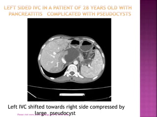 Congenital anomalies of IVC | PPTX