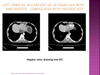 Congenital anomalies of IVC | PPTX
