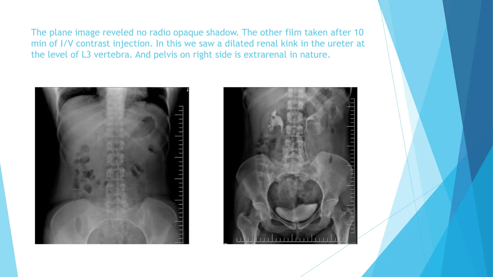 Congenital Anomalies of Kidney bt dr. shahariar | PPTX