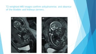 Congenital Anomalies of Kidney bt dr. shahariar | PPTX
