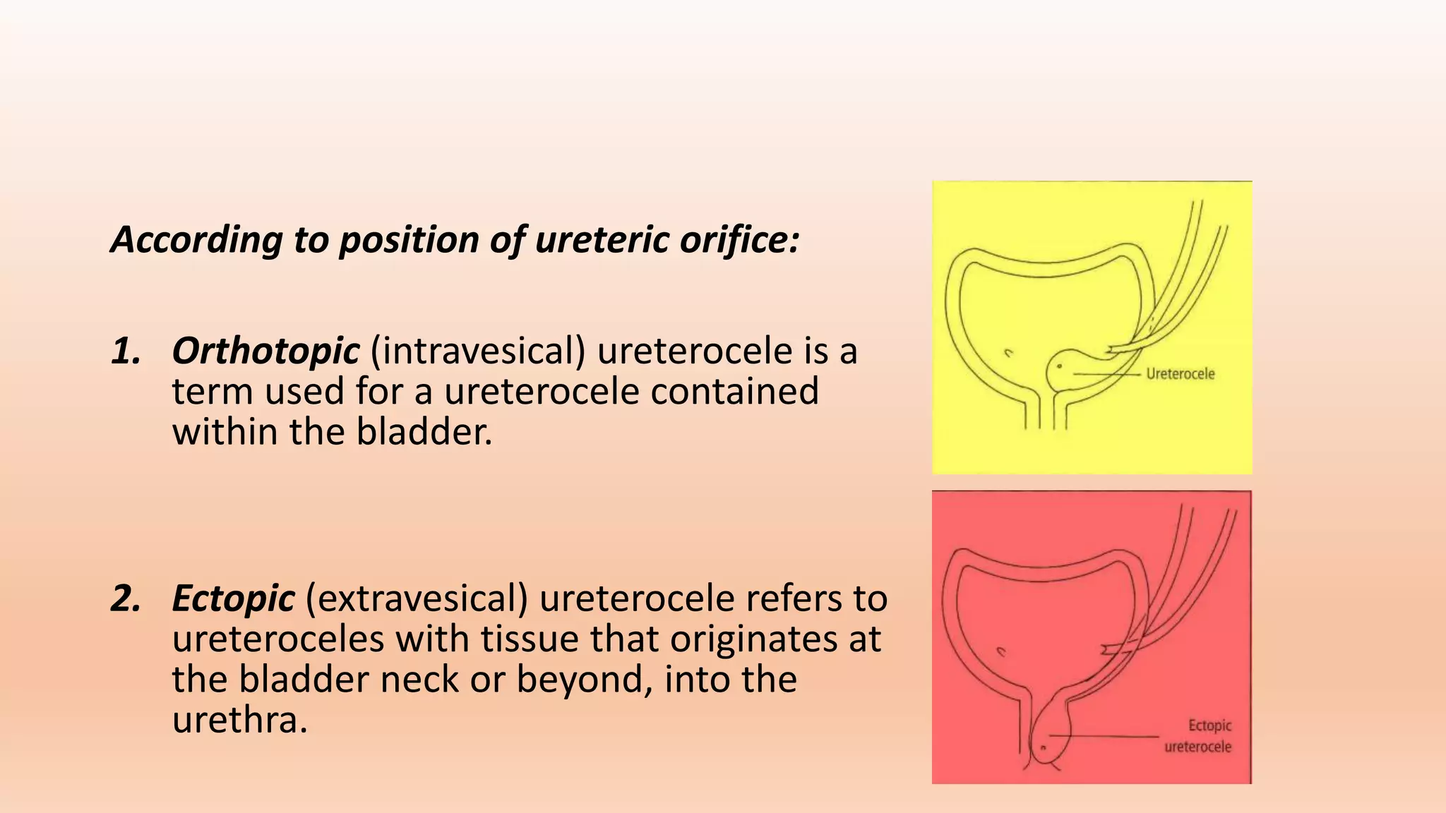 Congenital anomalies of kidney and urinary tract | PDF