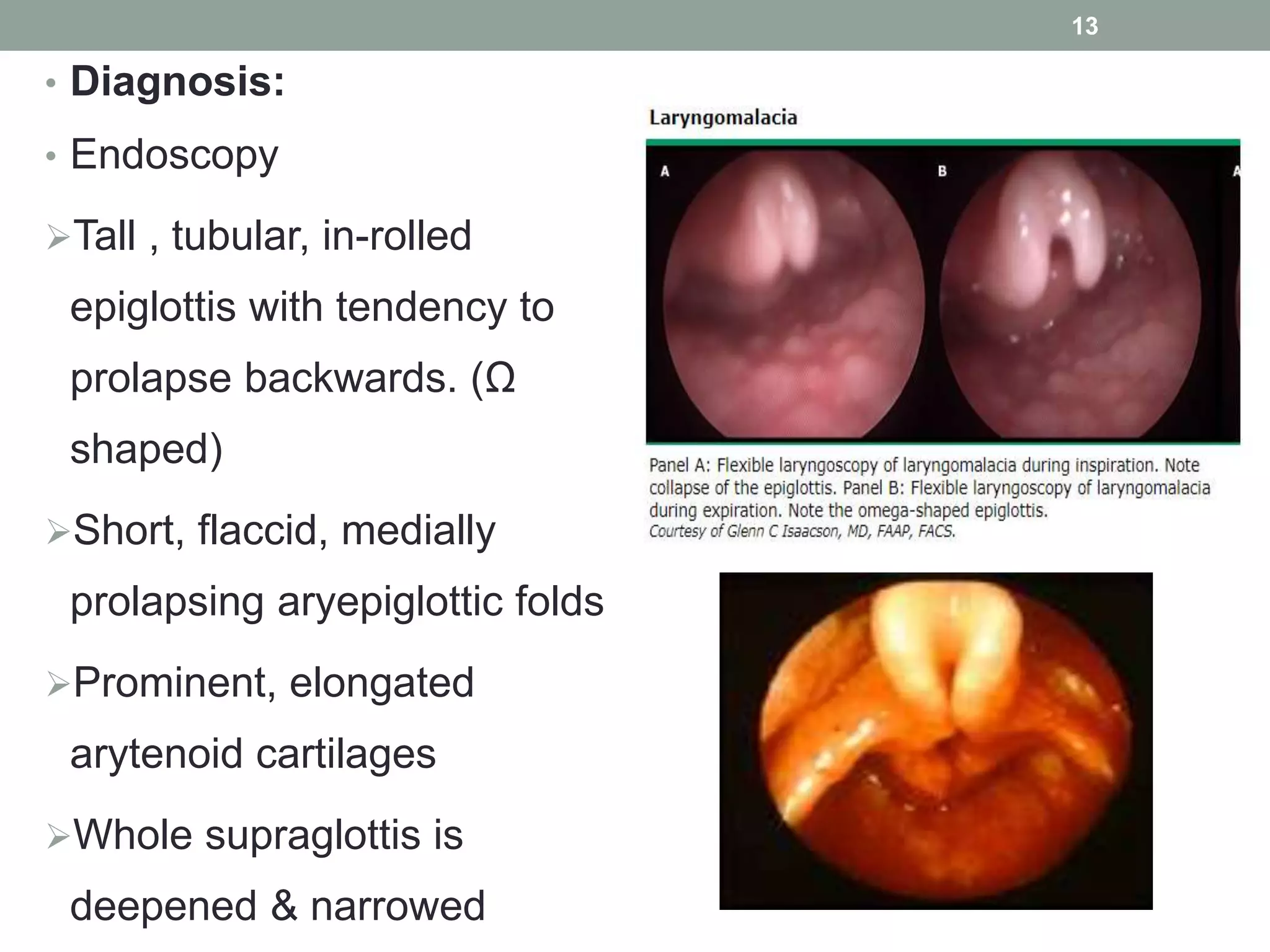 Congenital anomalies of larynx | PPTX