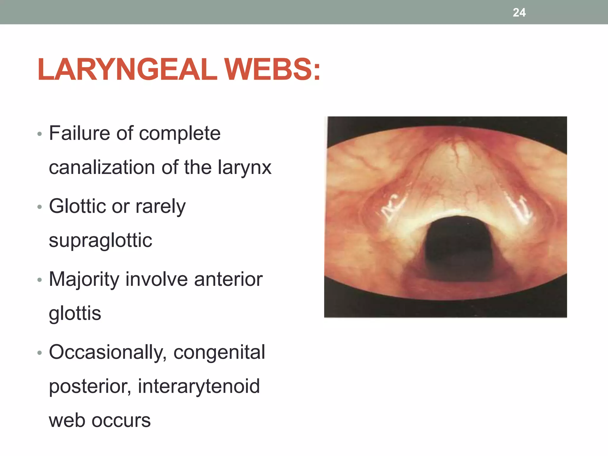 Congenital anomalies of larynx | PPTX