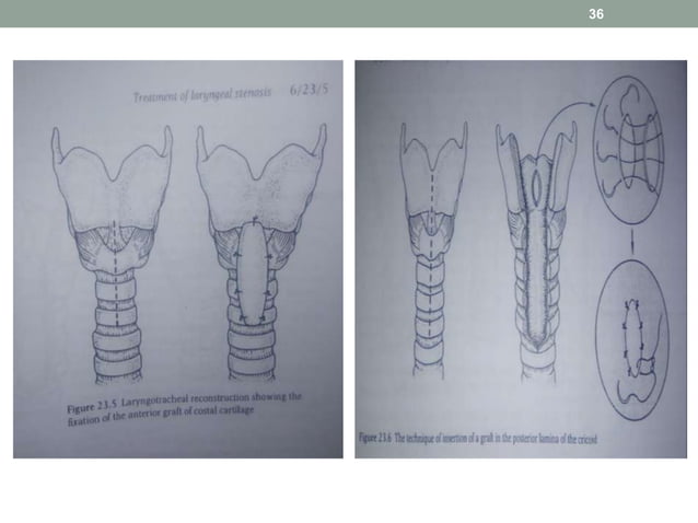 Congenital anomalies of larynx | PPTX | Ear, Nose and Throat Conditions ...