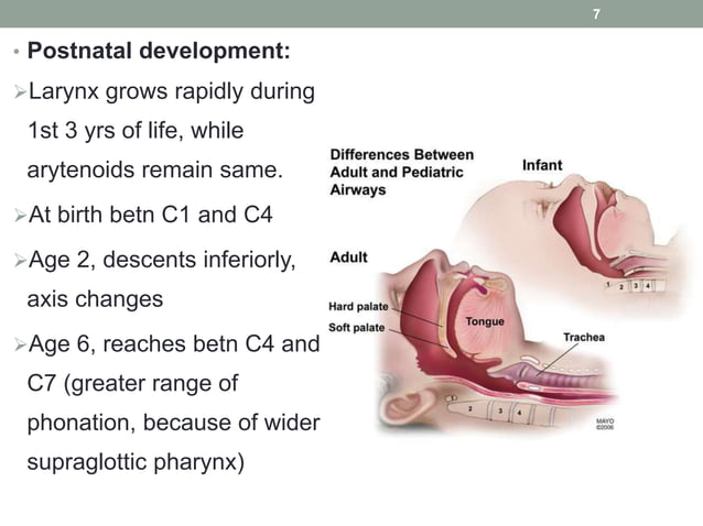 Congenital anomalies of larynx | PPTX | Ear, Nose and Throat Conditions ...