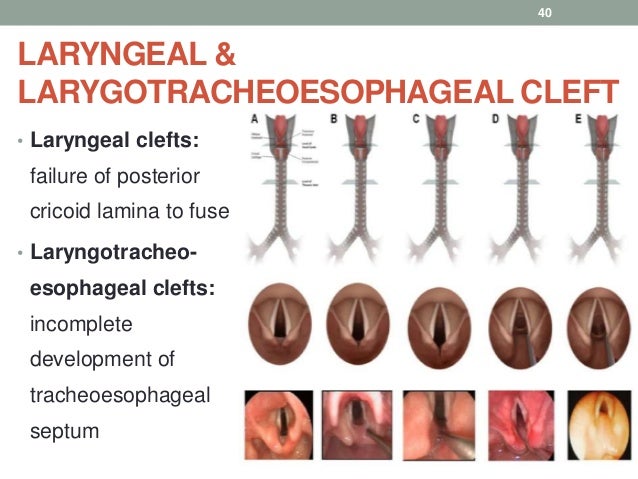 Congenital Anomalies Of Larynx