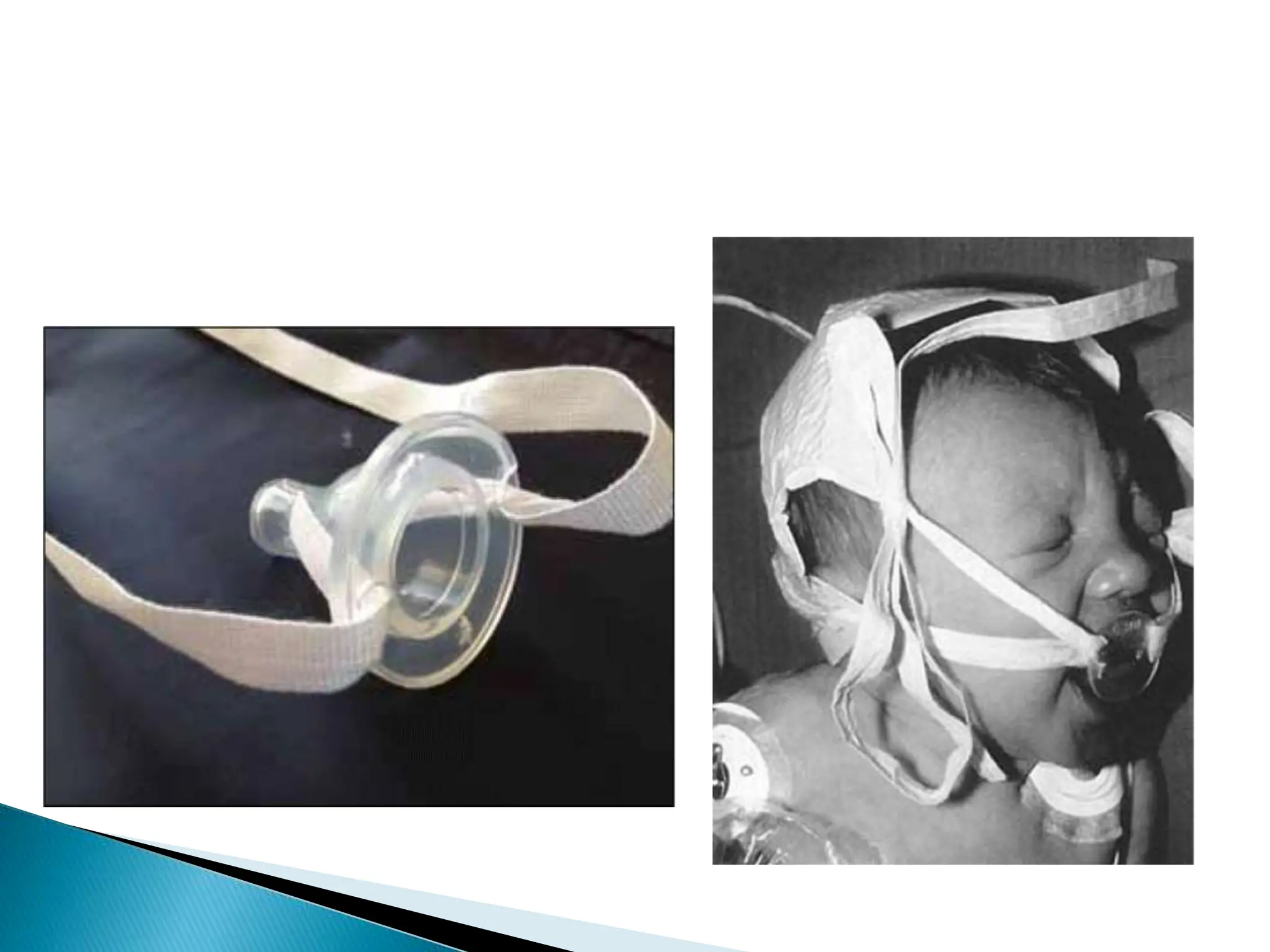 congenital anomalies of nose and PNS.pptx