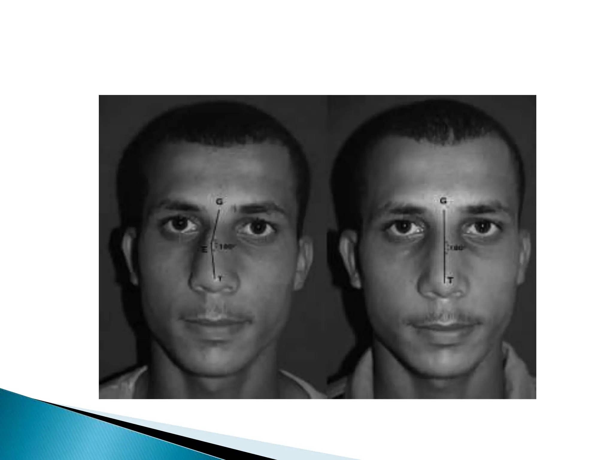 congenital anomalies of nose and PNS.pptx